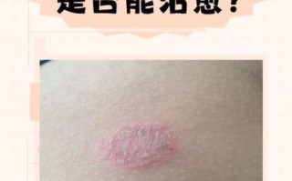 玫瑰糠疹传染吗_玫瑰糠疹会传染给家人吗