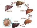 早期肝硬化能逆转吗_肝纤维化怎么软化回来