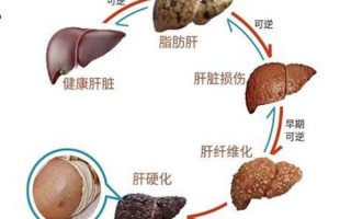早期肝硬化能逆转吗_肝纤维化怎么软化回来