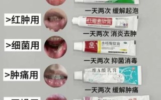 口腔溃疡怎么快速好_一夜治好的克星是什么