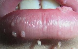 菜花肉芽早期症状图_如何辨别真假