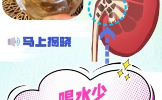 肾结石最怕三种饮水_如何正确喝水排石