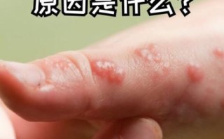 蛇胆疮是什么病_蛇胆疮怎么治疗最快