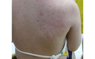 蚕豆过敏症状_蚕豆病不能吃蚕豆吗