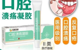 口腔溃疡特效药有哪些_怎么快速止痛