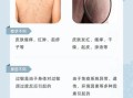 过敏性皮炎图片和症状_怎么判断是不是过敏性皮炎