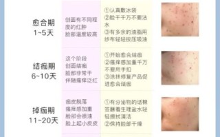 祛斑效果最好的方法_如何快速祛斑不反弹