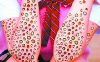 蓬蓬乳是什么_蓬蓬乳怎么治疗