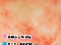 西瓜皮敷脸有什么好处_西瓜皮敷脸的正确方法