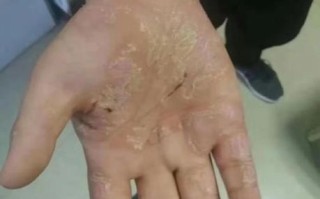 鹅掌风是怎么回事_鹅掌风是怎么引起的