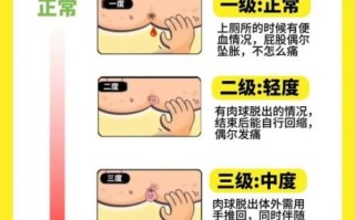 痔疮肉球怎么消除_痔疮肉球消除小偏方