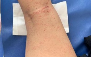 海蜇什么人不能吃_海蜇过敏症状有哪些