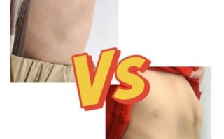 小孩鸡胸长大后图片_鸡胸成年后会变正常吗