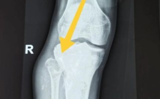 骨肉瘤图片怎么看_早期症状识别