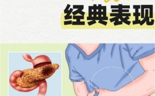 胰腺癌早期症状有哪些_胰腺癌能活多久