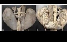 马蹄肾超声表现_马蹄肾超声能确诊吗