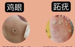 鸡眼图片长什么样_鸡眼和跖疣区别图解