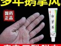 鹅掌风怎么治疗_鹅掌风用什么药膏好