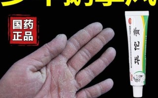鹅掌风怎么治疗_鹅掌风用什么药膏好