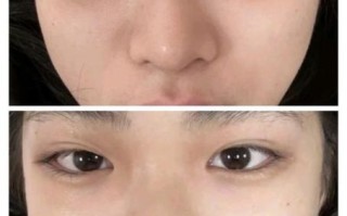 黑眼圈激光一次多少钱_效果能维持多久