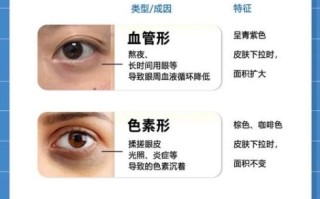 长期黑眼圈能消除吗_如何彻底淡化黑眼圈