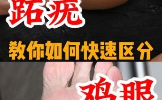 鸡眼是怎么形成的_鸡眼和跖疣的区别