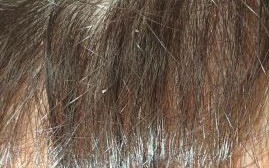 虱子怎么去除最快方法_虱子卵怎么彻底清除