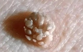 男性菜花状疣不痛不痒_会自愈吗