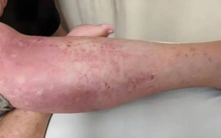 女性尿酸高的早期表现_尿酸高初期症状有哪些