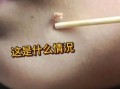 长菜花是什么病_长菜花初期症状有哪些