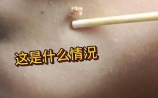 长菜花是什么病_长菜花初期症状有哪些