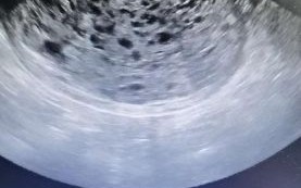 葡萄胎图片什么样子_典型特征有哪些