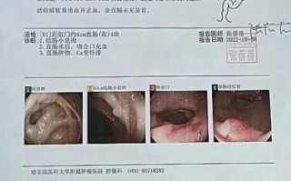 直肠癌晚期能治好吗_晚期直肠癌治愈案例