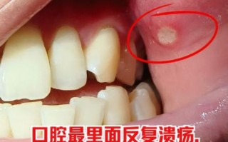 口腔溃疡长什么样_怎么判断是不是口腔溃疡
