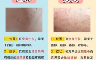 皮炎和湿疹的区别图片_怎么分辨