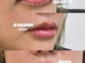 香肠嘴怎么改善_厚唇变薄自然方法