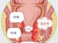 女性痔疮图片_痔疮长什么样