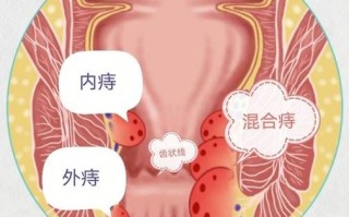 女性痔疮图片_痔疮长什么样