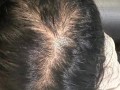 脂溢性脱发能自愈吗_脂溢性脱发好了还会复发吗