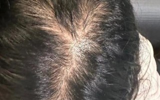 脂溢性脱发能自愈吗_脂溢性脱发好了还会复发吗