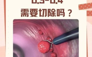 直肠息肉会癌变吗_直肠息肉切除后多久恢复