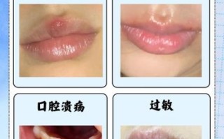 嘴唇起泡是什么原因_睡一觉醒来上唇肿了怎么办