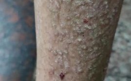 淀粉样变性是什么病_能活多久