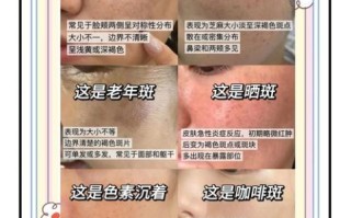 祛斑去医院还是美容院好_哪个更安全有效