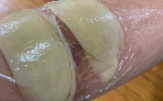 土豆片消肿的正确方法_土豆片敷多久能消肿