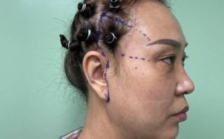 拉皮手术是怎么做的_拉皮手术全过程