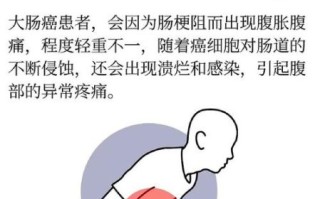 直肠癌的早期症状有哪些_直肠癌早期会疼吗