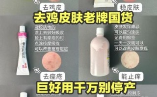 鸡皮肤怎么治疗_鸡皮肤用什么药膏最有效