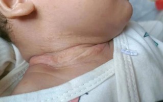 蚕豆病发作症状图片_蚕豆病图片怎么看