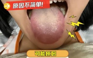 草莓舌苔是怎么回事_草莓舌苔是病吗